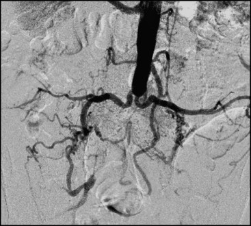 Blockage Below the Belt: Leriche Syndrome | The American Journal of ...